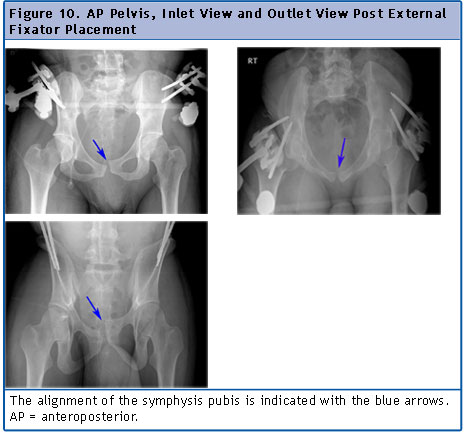 Pelvic Inlet View Bony Pelvis | Bones, Ligaments, Vasculature | Geeky